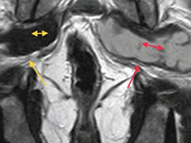 Pyomyositis of the piriformis muscle – A case of piriformis syndrome ...