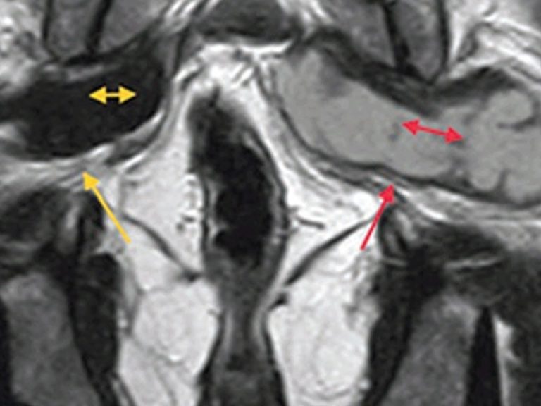 Pyomyositis of the piriformis muscle – A case of piriformis syndrome ...